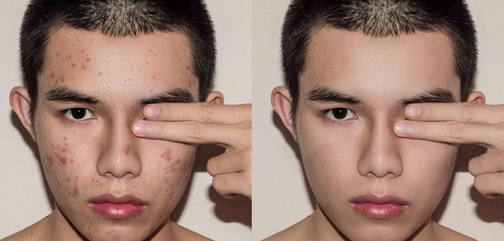 Skin Purging 101: Understanding and Managing the Process – Frank's ...