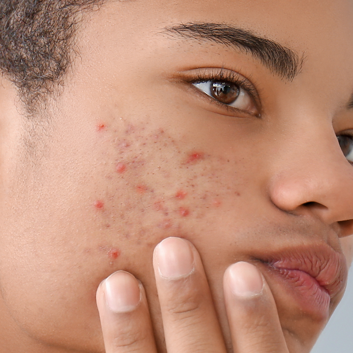 Clearing Face Cream - Best Face Moisturiser For Oily, Acne Prone Skin ...